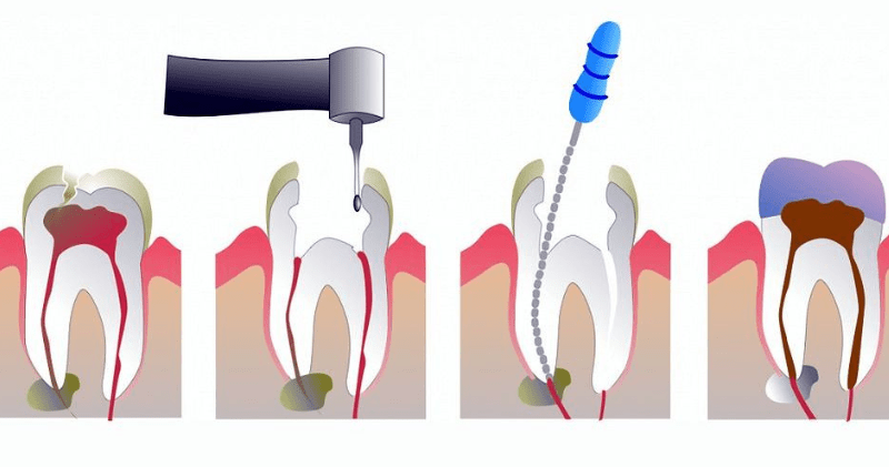 Pulpectomy/RCT Treatment in Whitefield, Bangalore | Smaya's Dento Care